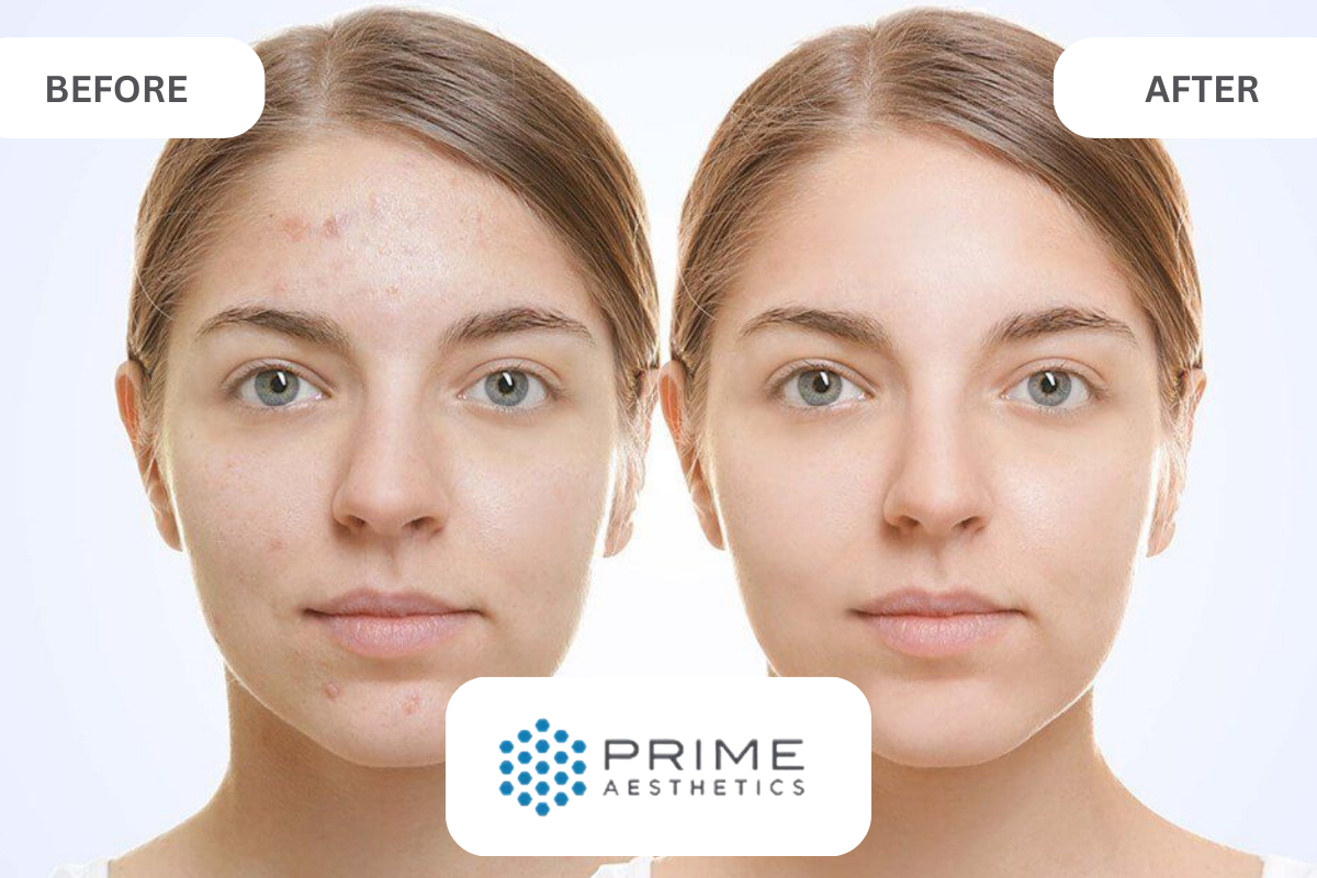 Proven Acne & Blemish Treatments by Prime Aesthetics Clinic