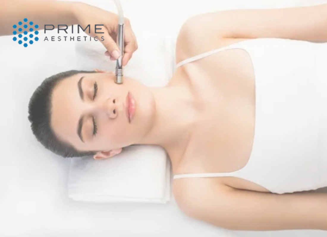 Best Diamond Microdermabrasion in Sevenoaks, Kent, UK