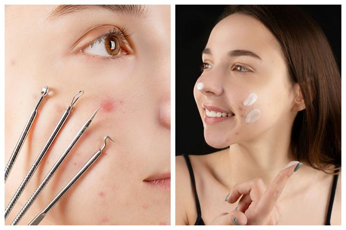 Tired of Milia That Won’t Go Away? Professional Milia Removal